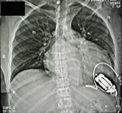 Implantation | Jarvik Heart Inc.